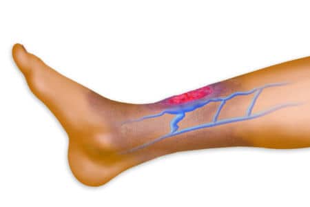 Хронична венозна недостатъчност и Entan | Ентан